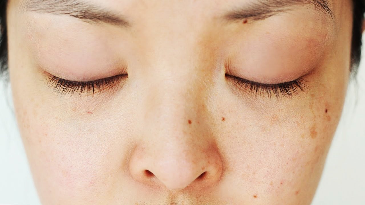 Apart From Pigmentation Dark Spots And Blemishes Can Also Impact Your